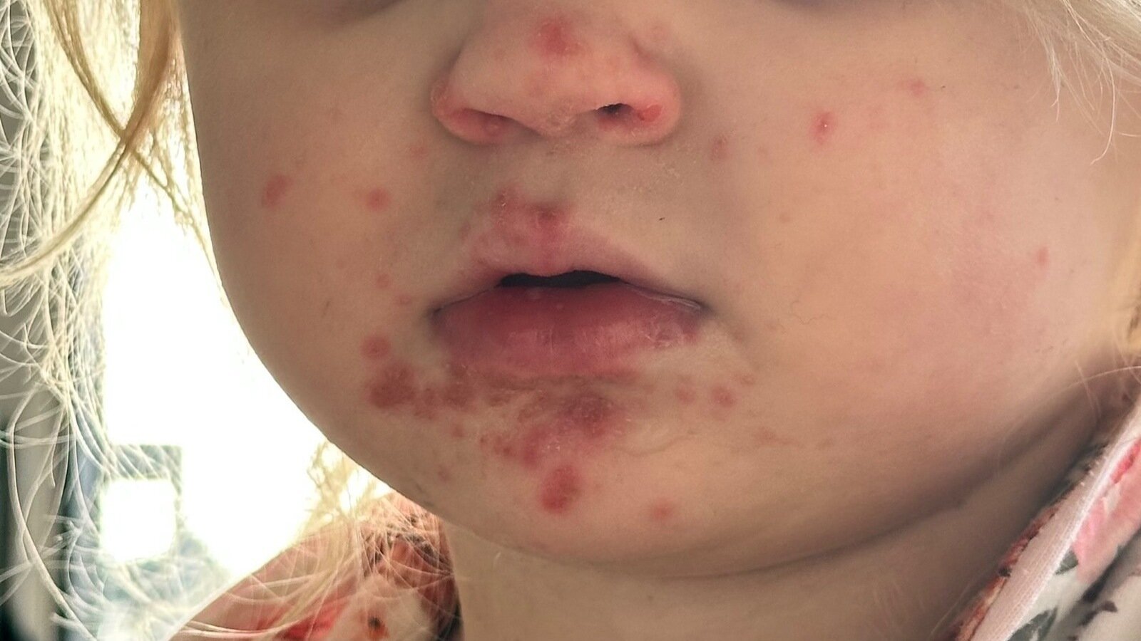 Petition · Revise NHS Guidelines for Handling Hand, Foot and Mouth ...