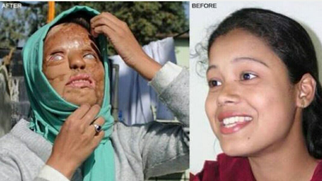 Petition · Need of Reservation for Acid Attack Victims - India · Change.org