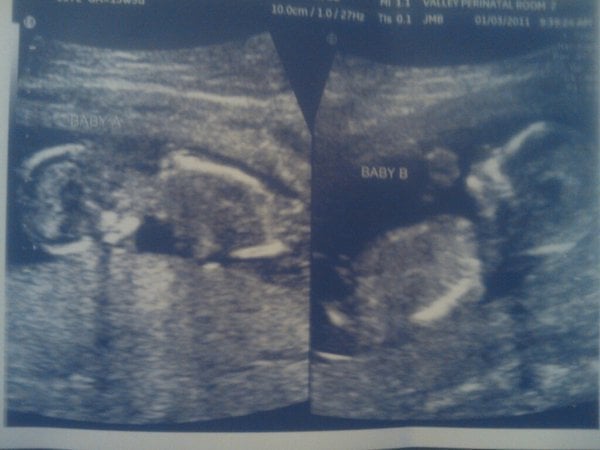 Petition · Recognize Stillborn Death For Multiples Earlier Than 20 ...