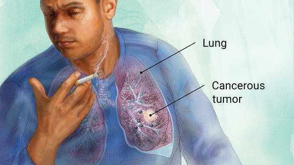 Petition · BAN INDOOR SMOKING IN ALL THE FLORIDA BARS - United States ...