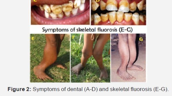 Petition · Help put a stop to unnecessary fluoride fortification of ...