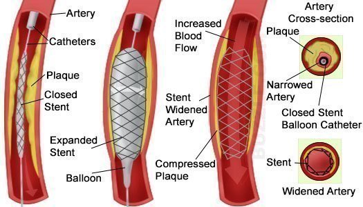 Petition · Bring pricing of coronary stents under NPPA - India · Change.org