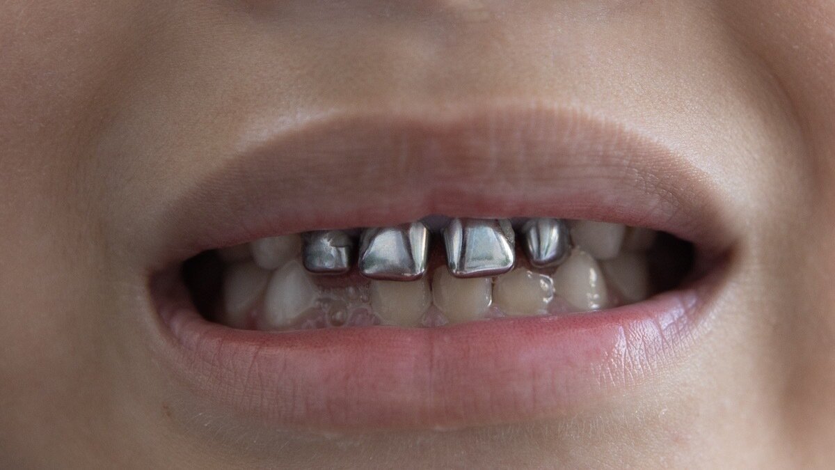 Petition · Stop silver crowns for kids - United States · Change.org